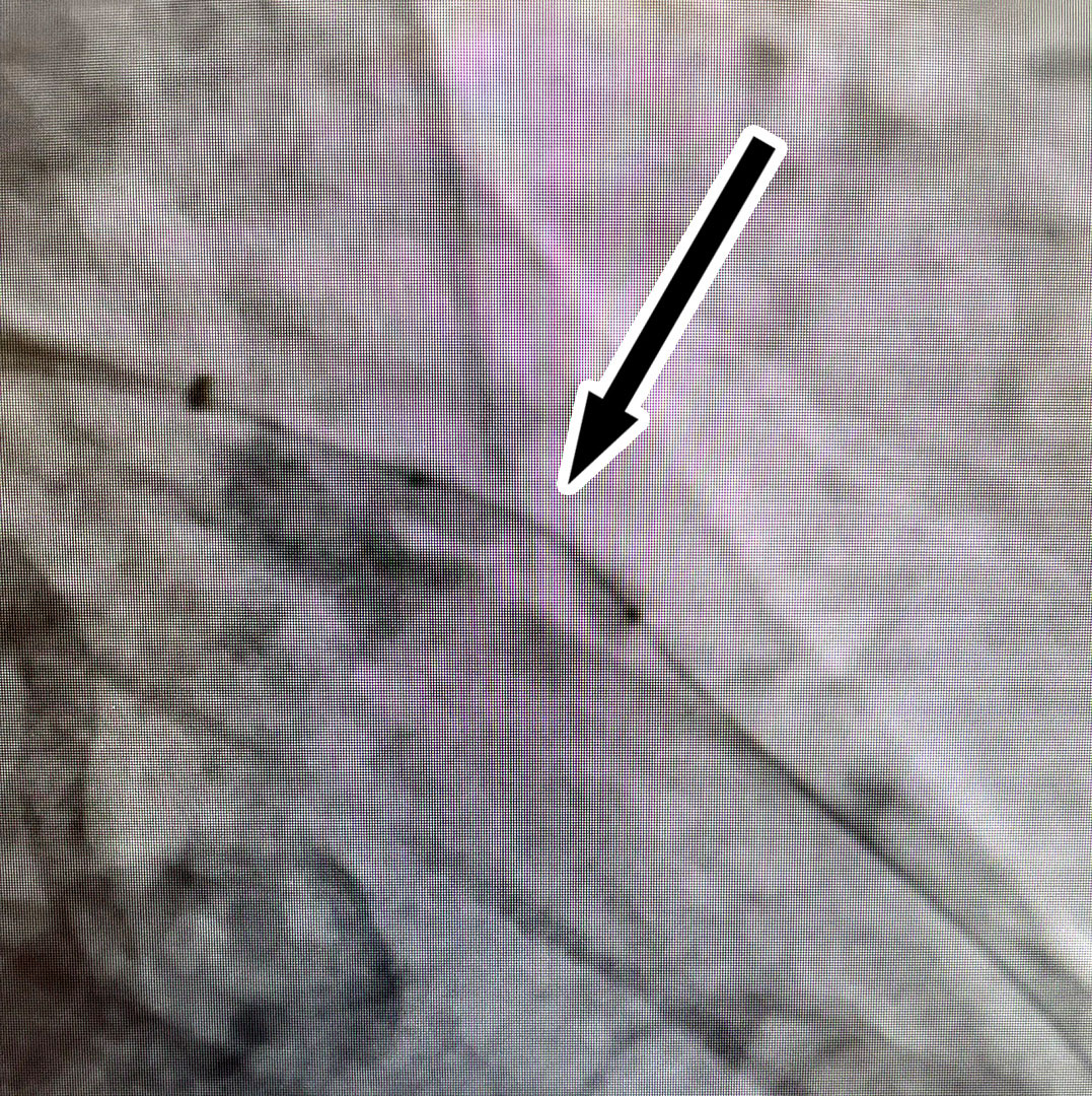 Intravascular Lithotripsy Therapy - New Treatment for Advanced Heart ...