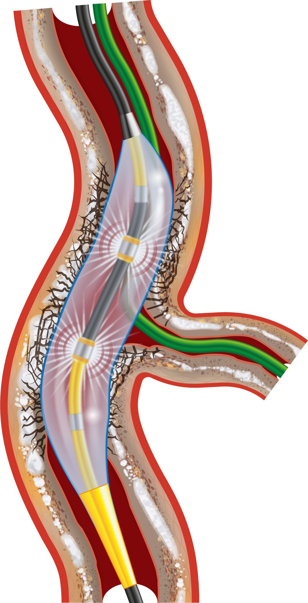 Shockwave Intravascular Lithotripsy System - Cardiovascular Interventions Orlando