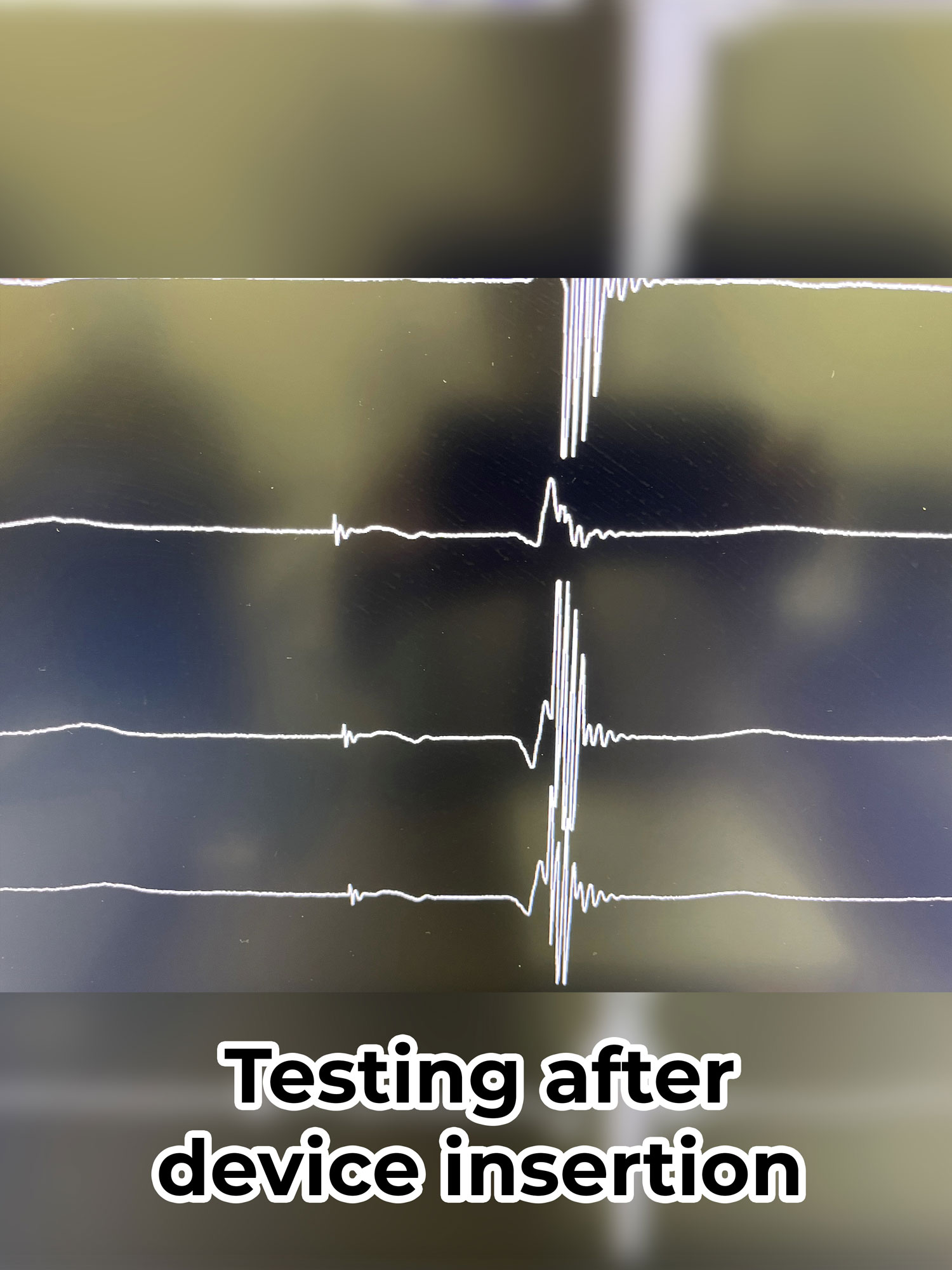 CCM Therapy from the Impulse Dynamics Optimizer Smart System ...